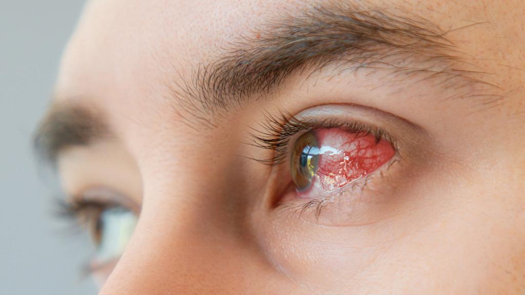 sudden onset cloudy eye